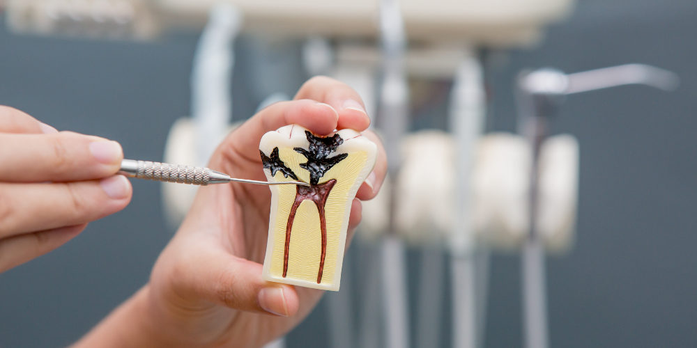 Endodontist To Treat Your Sensitive Teeth - Rockland Dental Specialists