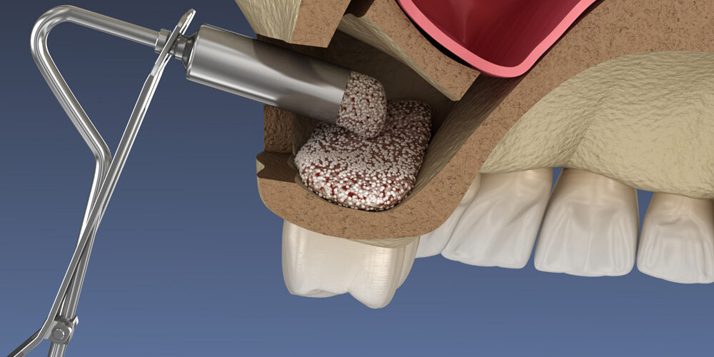 Sinus Lift: Why It's Needed for Dental Implants - Rockland Dental ...